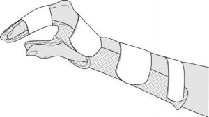 Materials Used in Splint Making: A Comprehensive Guide - Smart Splint